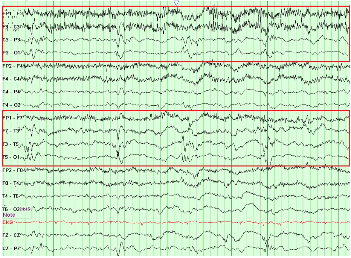Left hemispheric PLEDs