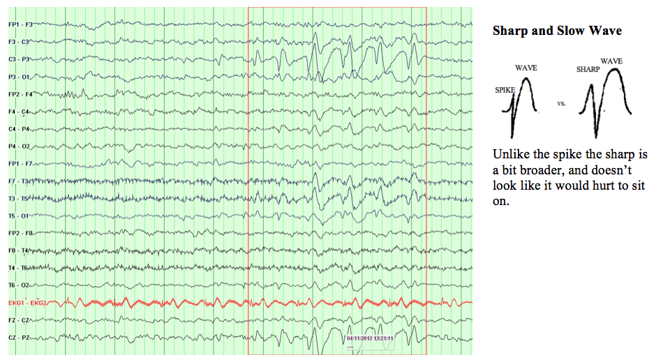 Examples of Interictal Epileptiform abnormalities are: